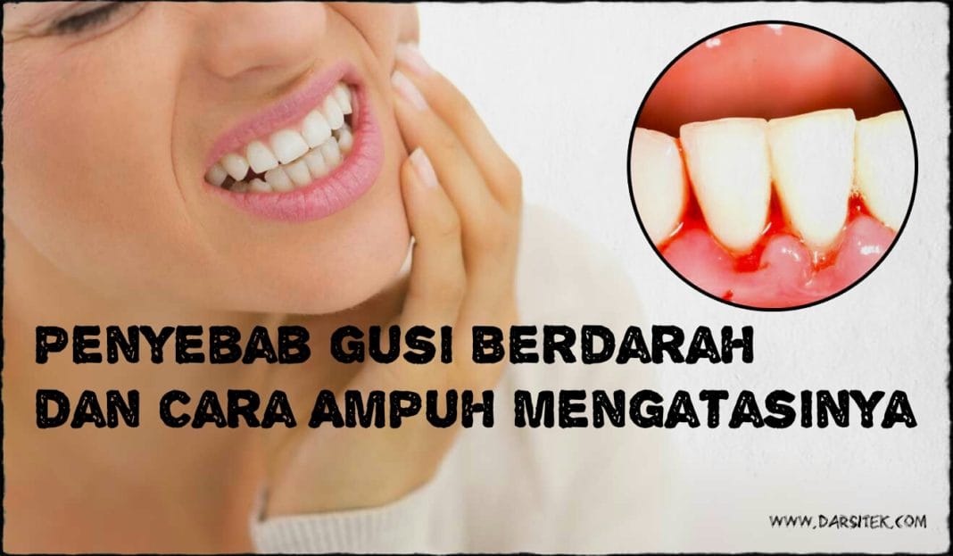 Penyebab Gusi Berdarah dan Cara Ampuh Mengatasinya - Asdar Id
